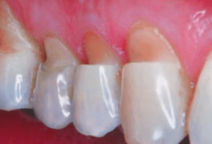 Dental abfraction: causes, symptoms and treatment - Janer Herraiz ...
