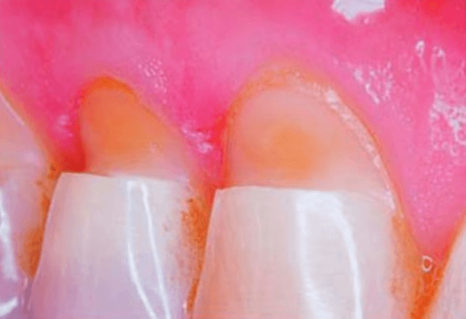 Abfracción dental: causas, síntomas y tratamiento - Janer Herraiz ...