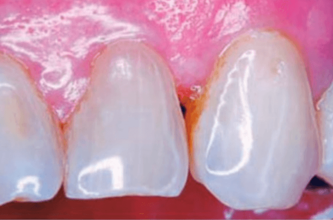 Dental abfraction: causes, symptoms and treatment - Janer Herraiz ...